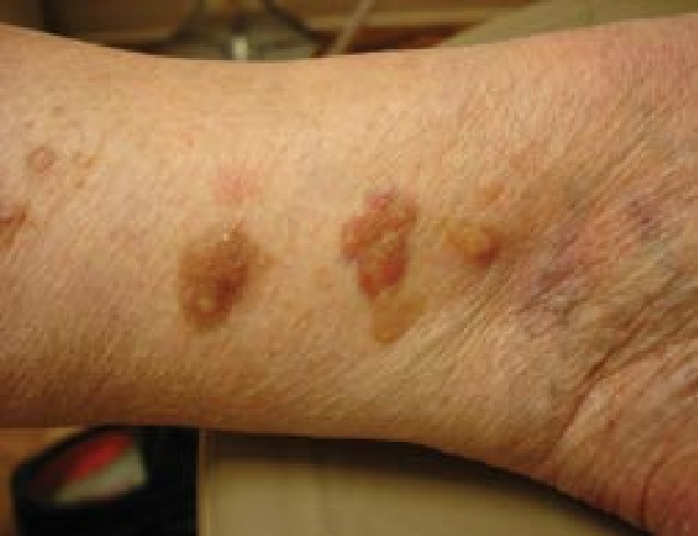 Figure 1 From Primary Localized Cutaneous Nodular Amyloidosis And Crest