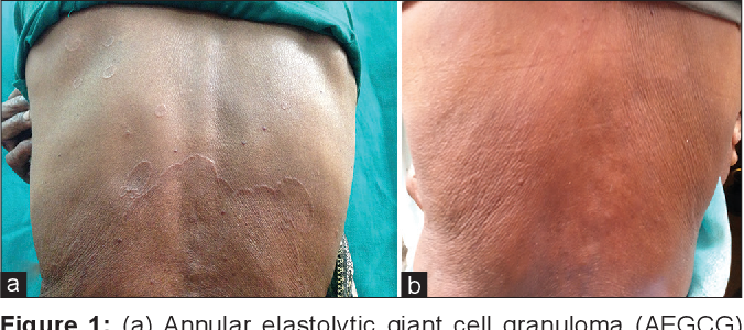 Figure 1 From Annular Elastolytic Giant Cell Granuloma In Association