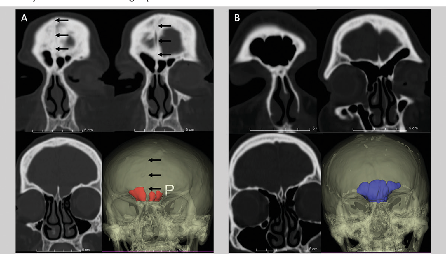 Pdf The Relation Between The Metopic Suture Persistence And Frontal