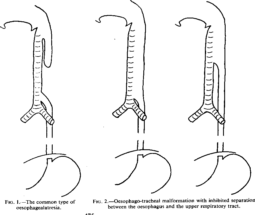 Figure 2 From The Treatment Of Oesophageal Atresia Semantic Scholar