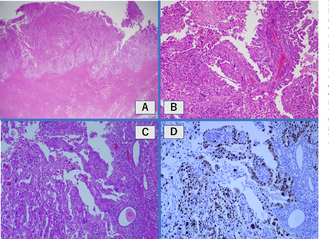 Figure 1 From Recurrent Uterine Serous Carcinoma With A Germline