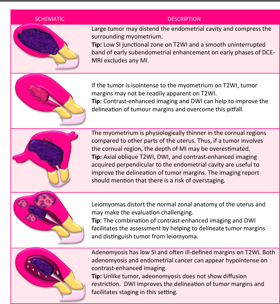 Figo Uterine Cancer Staging