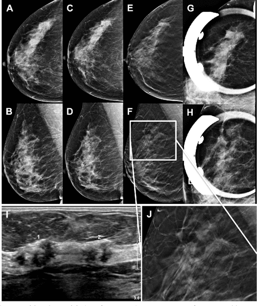 Figure 5 From Emerging Modalities In Breast Cancer Imaging Semantic