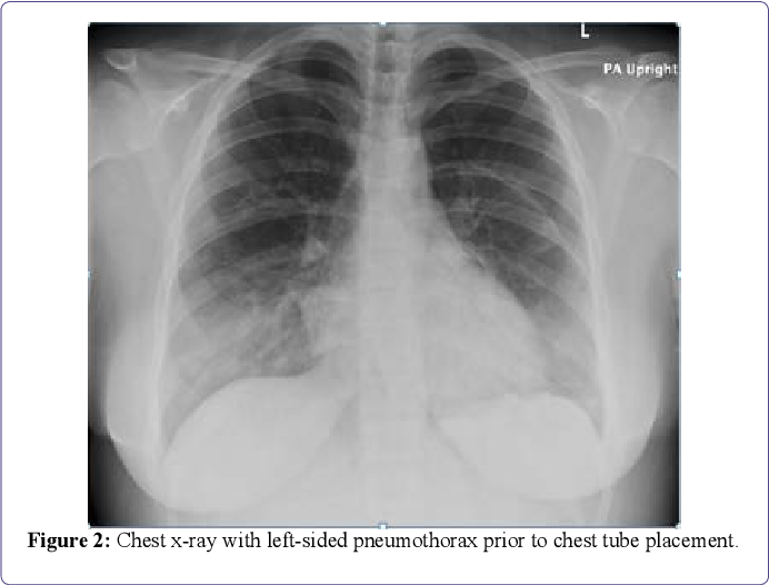 Pdf Pneumothorax In A Spontaneously Breathing Post Partum Woman With