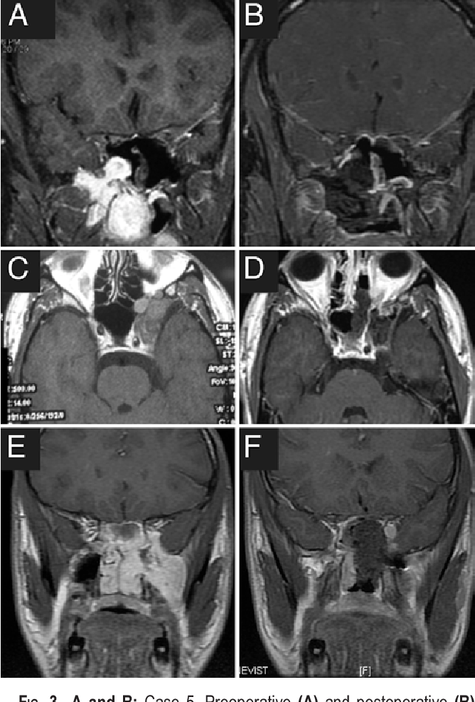 Figure 1 From The Endoscopic Endonasal Transmaxillary Transpterygoid