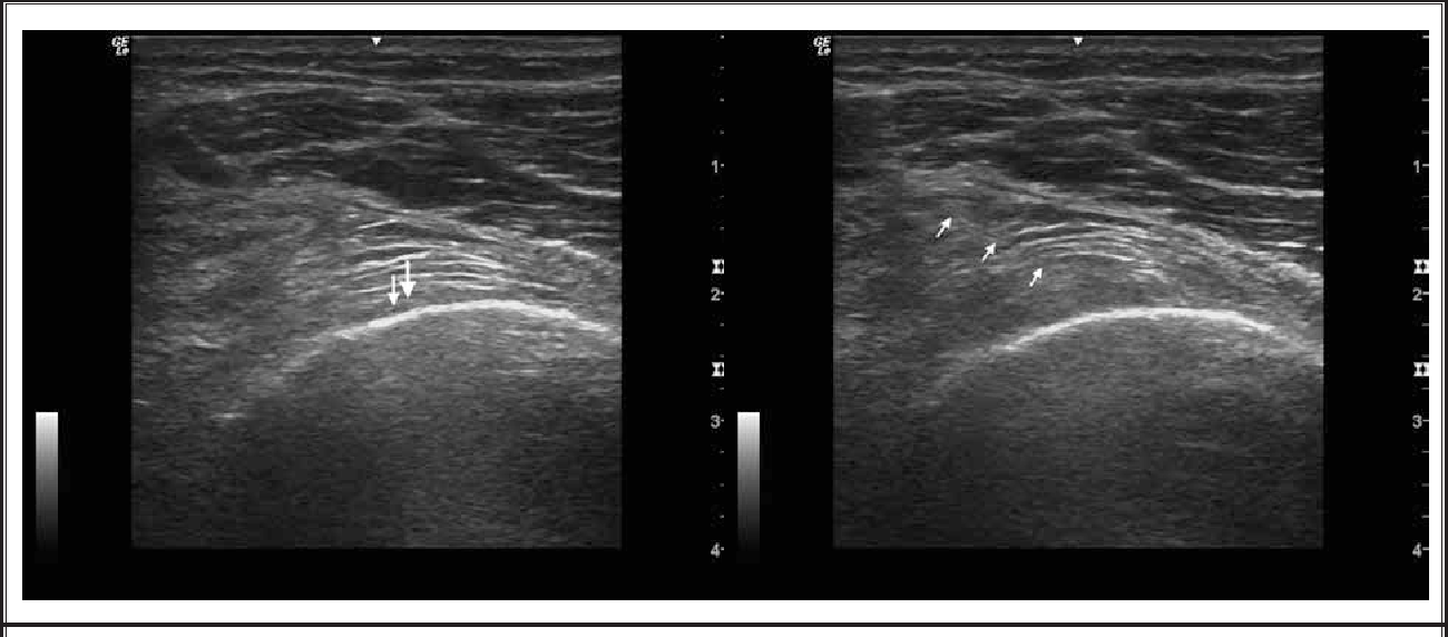 Genicular Nerve Block Cpt