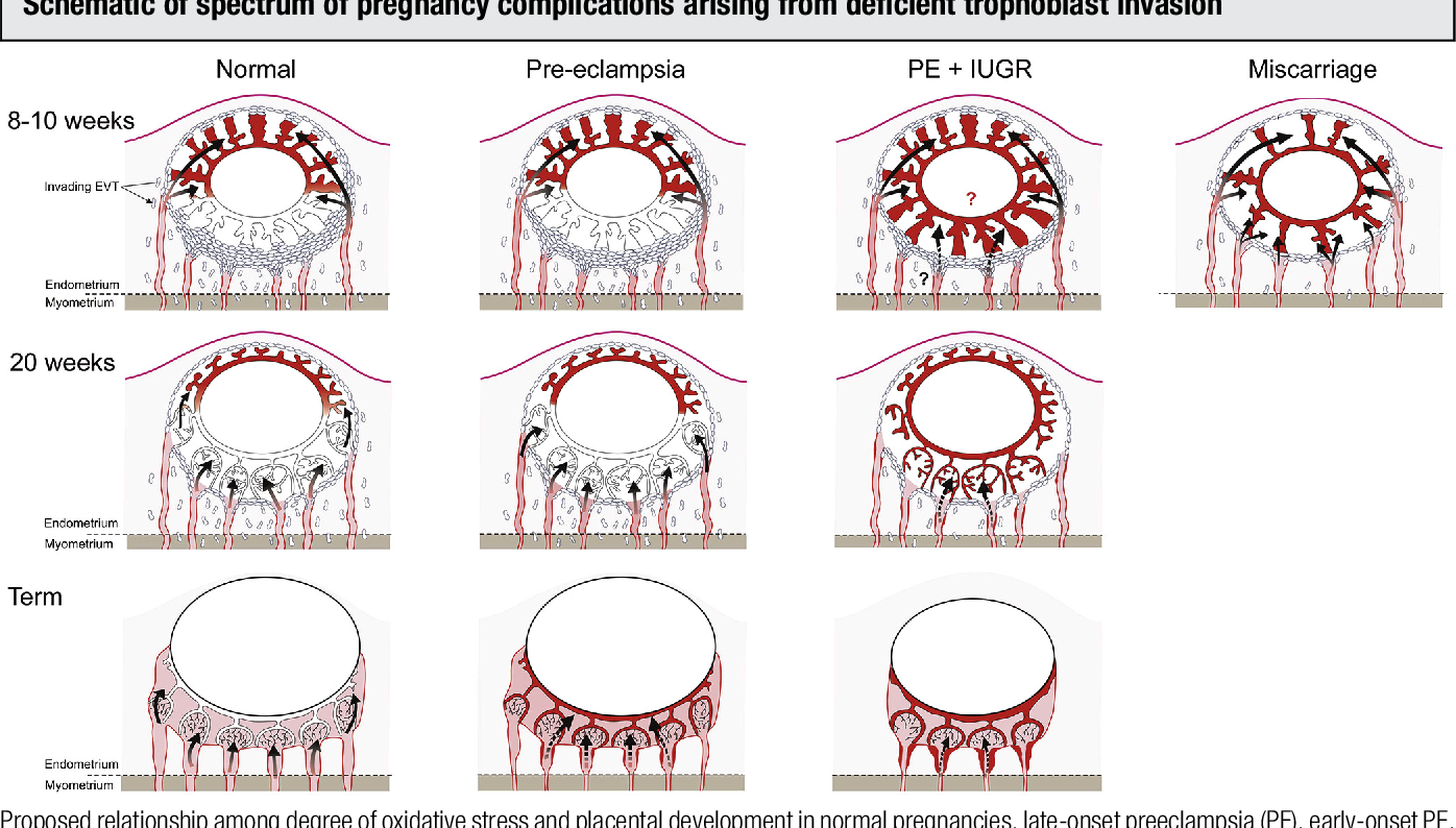 Pathophysiology Of Placental‐derived Fetal Growth Restriction