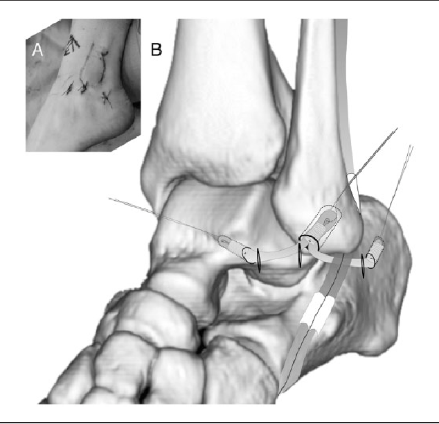 Figure 4 From Percutaneous Ankle Reconstruction Of Lateral Ligaments