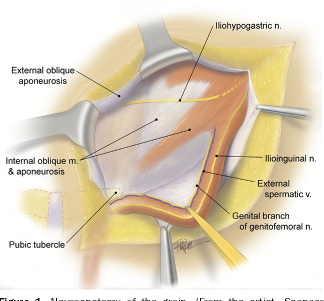 Figure 1 From Surgical Treatment Of Chronic Groin And Testicular Pain