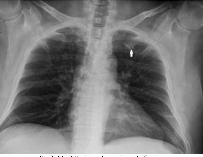 Figure 2 From A Study Of Calcification Of Costal Cartilages 1st To 7th