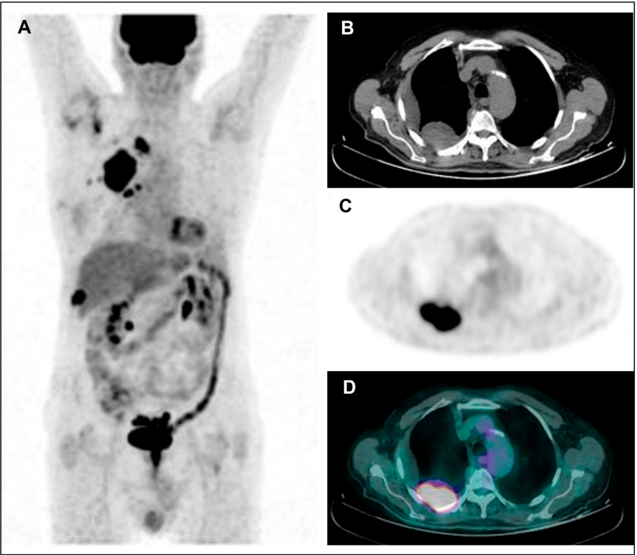 Figure 1 From The Prognostic Value Of 18f Fdg Pet Imaging At Staging In