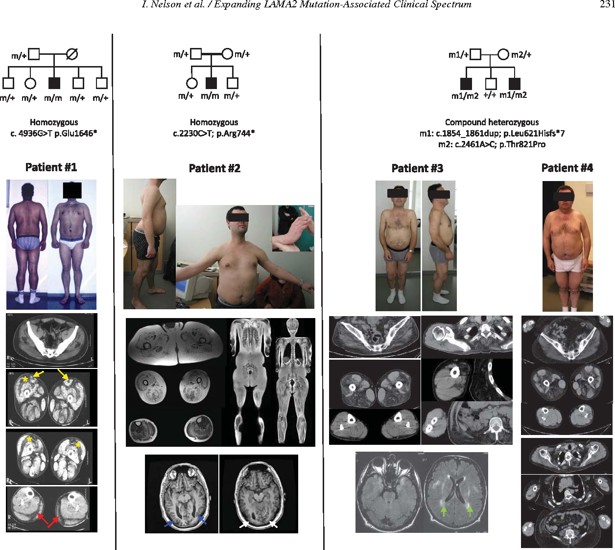 Figure 1 From Laminin α2 Deficiency Related Muscular Dystrophy