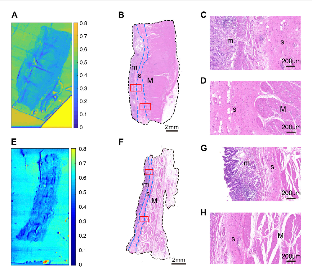 Early Detection Of Gastric Cancer Via High Resolution Terahertz Imaging