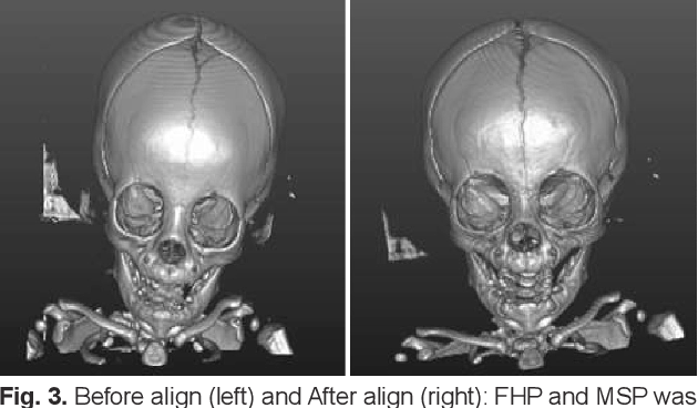 Pdf Generation And Detection Of Cranial Landmark Semantic Scholar