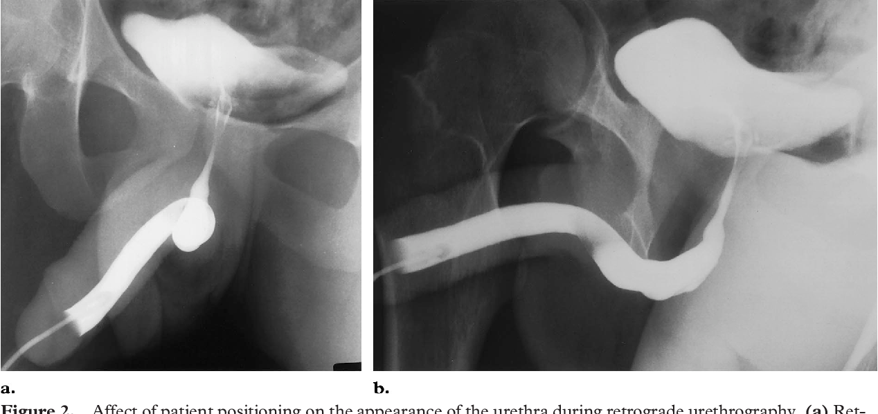 Figure 1 From Imaging Of Urethral Disease A Pictorial Review