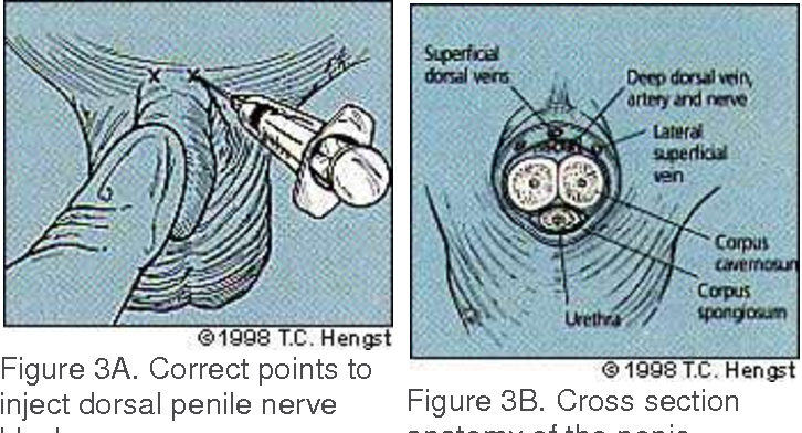 Circumcision Procedure Steps