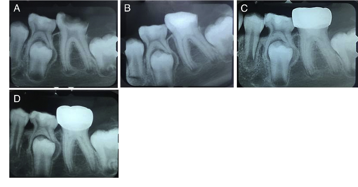 Table 1 From Full Pulpotomy With Biodentine In Symptomatic Young