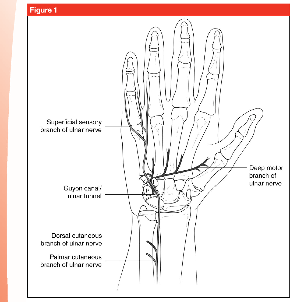 Figure 2 From Ulnar Nerve Entrapment At The Wrist Semantic Scholar