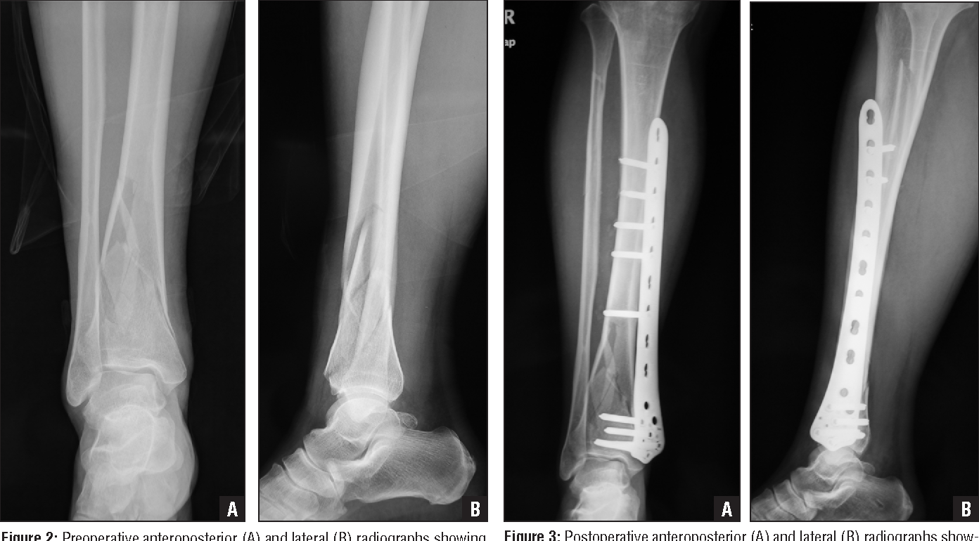 Figure 4 From Surgical Treatment Of Extra Articular Or Simple Intra