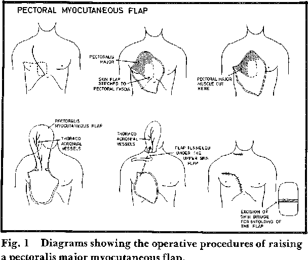 The Pectoralis Major Flap Springerlink 47 Off