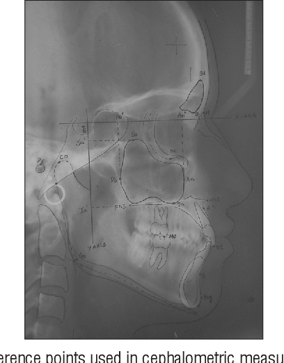 Figure 1 From Reliability Of Frontal Sinus With That Of Maxillary Sinus