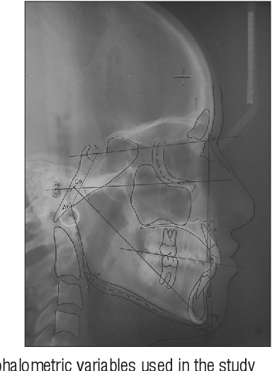 Figure 1 From Reliability Of Frontal Sinus With That Of Maxillary Sinus