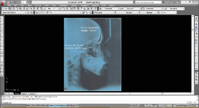 Figure 1 From Reliability Of Frontal Sinus With That Of Maxillary Sinus