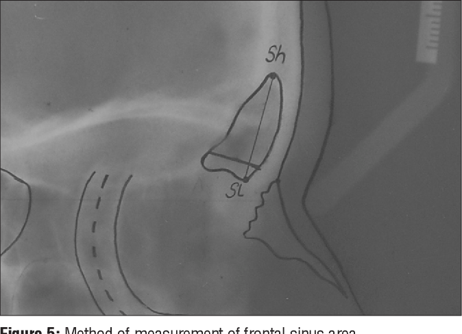 Figure 1 From Reliability Of Frontal Sinus With That Of Maxillary Sinus