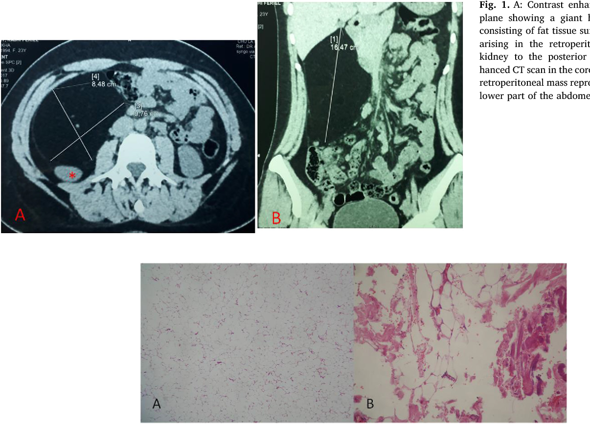 Fatty Tumors Of The Retroperitoneum Lipoma Or Well Differentiated