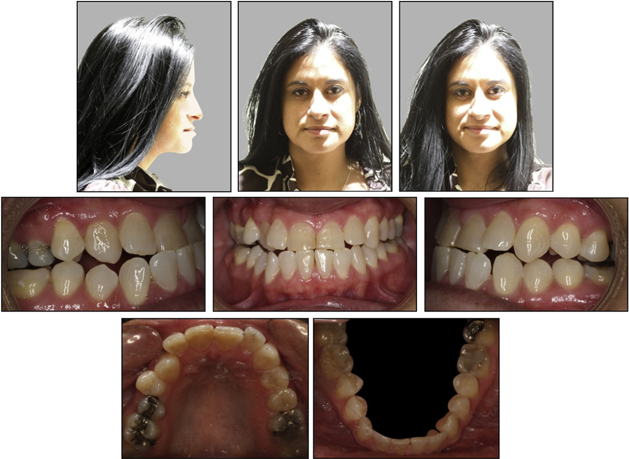 Figure 1 From Camouflage Treatment Of Skeletal Class Iii Malocclusion