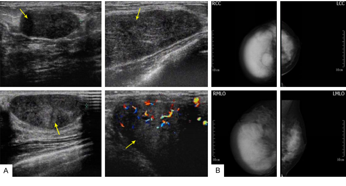 Figure 3 From Multiple And Giant Juvenile Fibroadenoma A Case Report