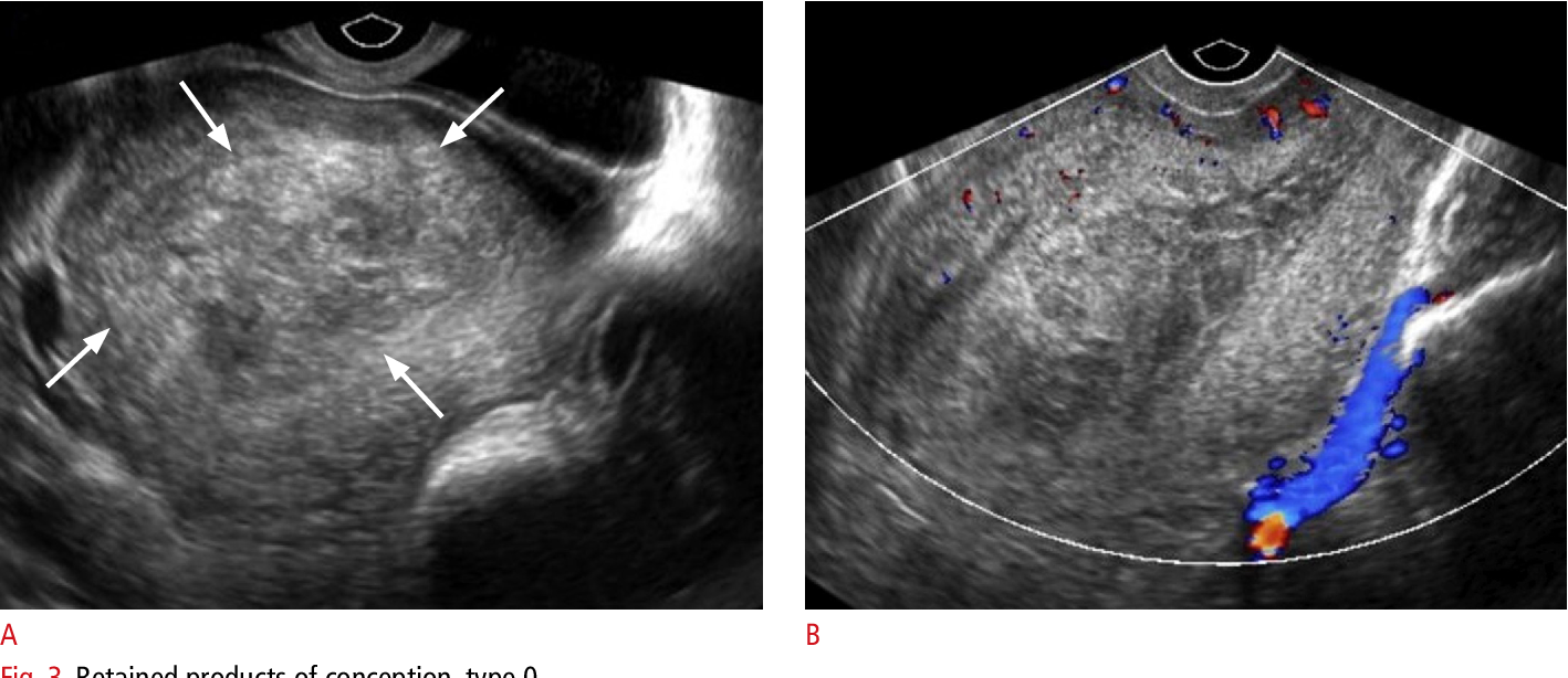 Figure 2 From Pelvic Ultrasonography Of The Postpartum Uterus In