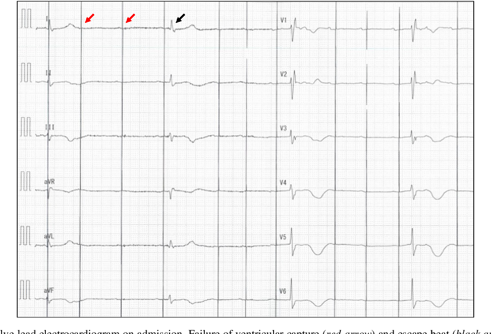 Figure 1 From Very Late Phase Perforation Of The Septum And Left