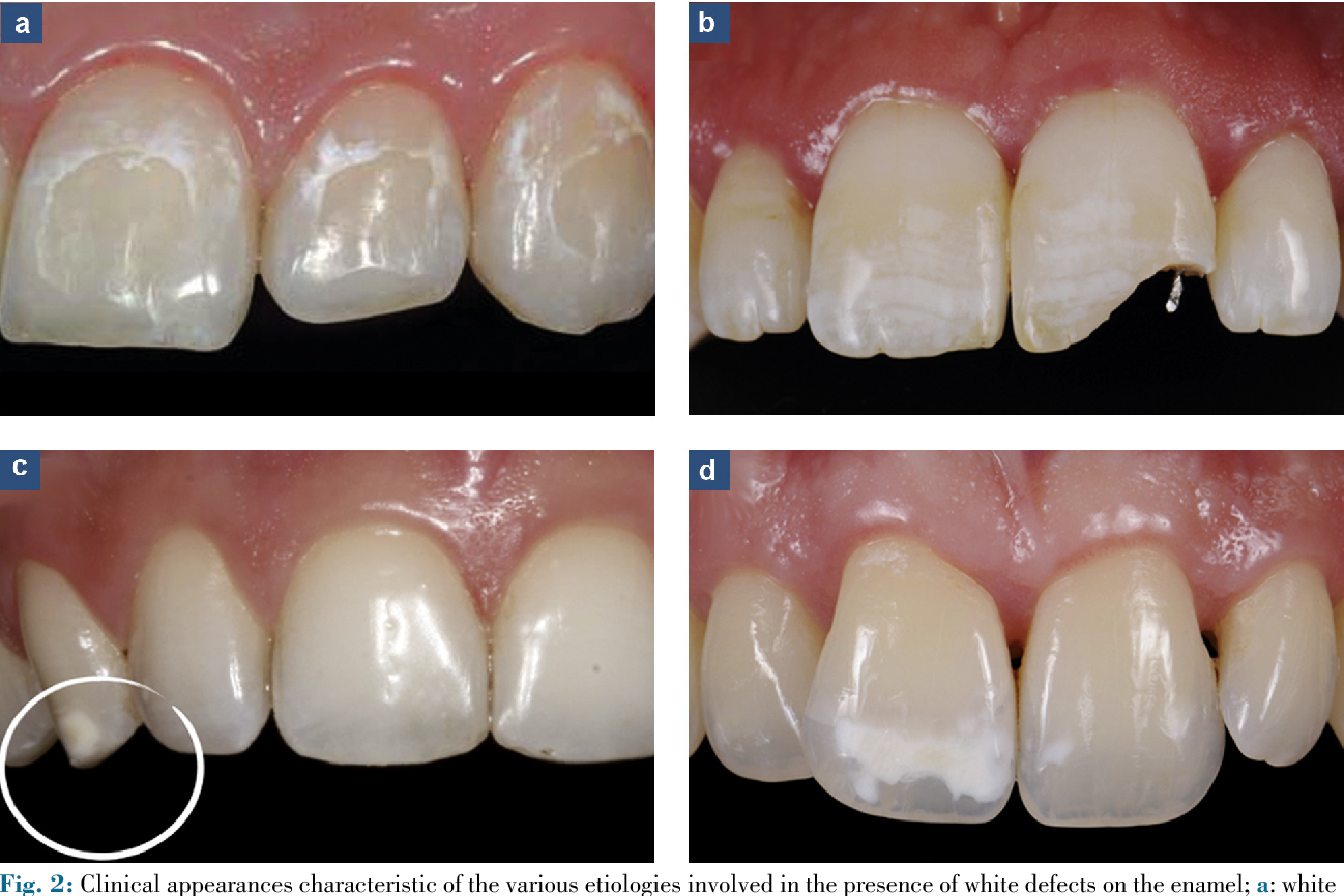 Figure 19 From White Defects On Enamel Diagnosis And Anatomopathology