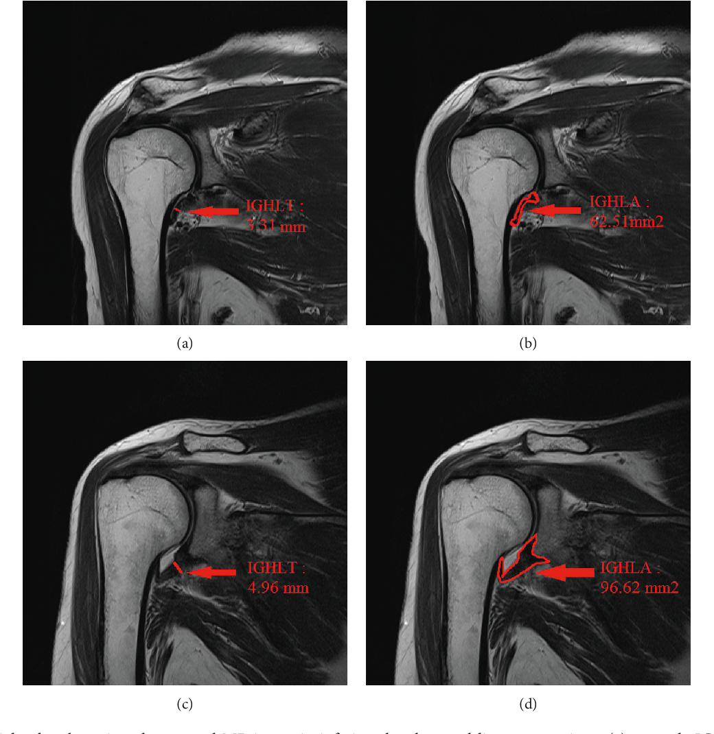 Pdf Value Of Anterior Band Of The Inferior Glenohumeral Ligament Area