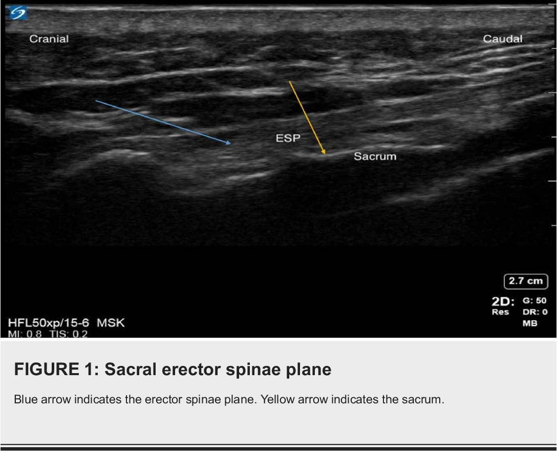 Figure 1 From Sacral Erector Spinae Plane Block For Gender Reassignment
