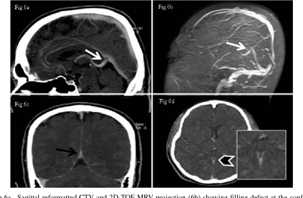 Cerebral Venous Sinus Thrombosis Mrv Review Of The Scientific Literature