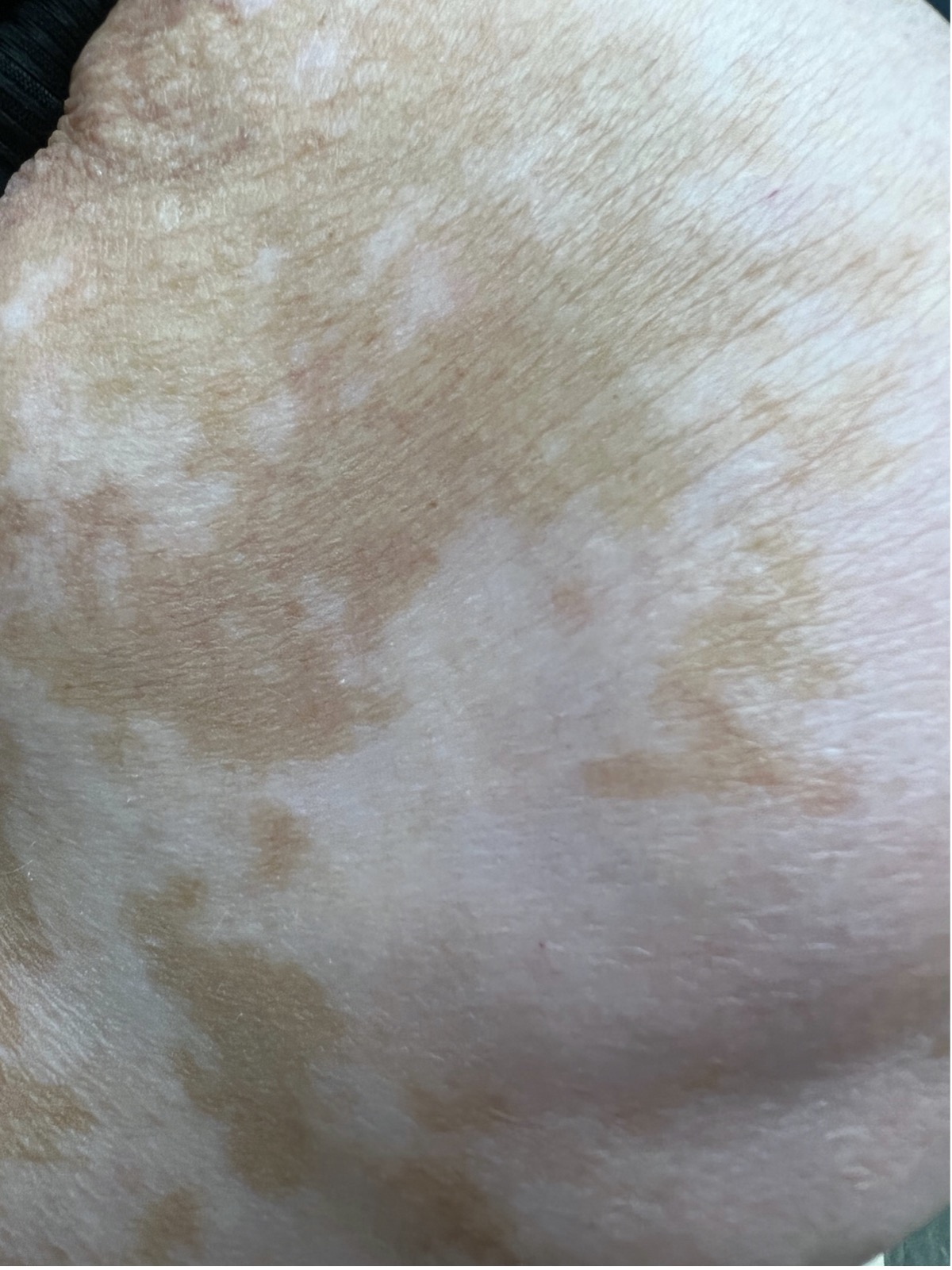 How I Treat Vitiligo Case Presentation The Dermatologist