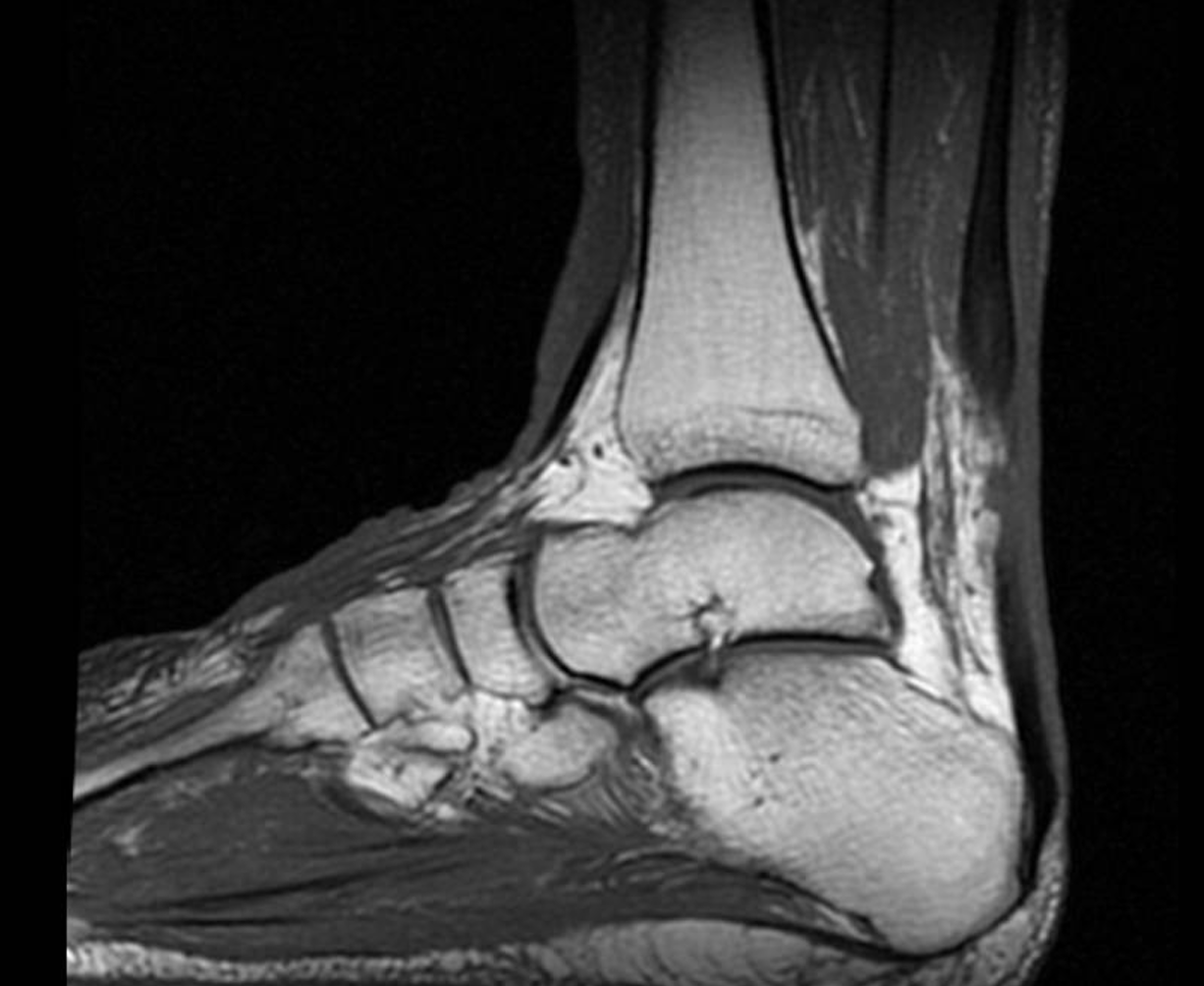 Spontaneous Bilateral Achilles Tendon Ruptures