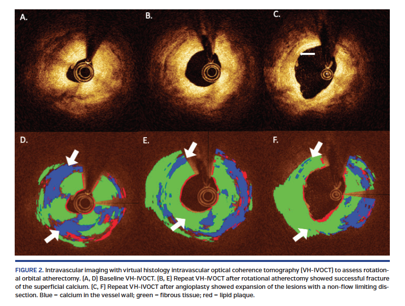 Virtual Histology Optical Coherence Tomography Imaging Of Orbital