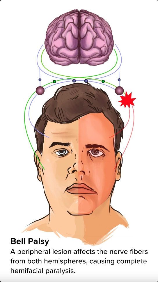 Hd Bell Palsy Vs Stroke Emrap