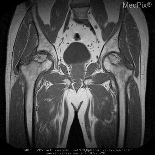 Avascular Necrosis Of Femoral Head Mri