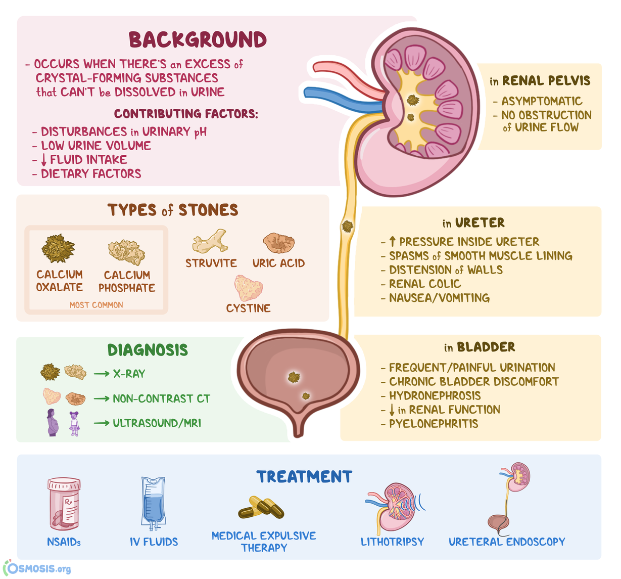 Nephrolithiasis What Is It Types Signs And Symptoms Diagnosis