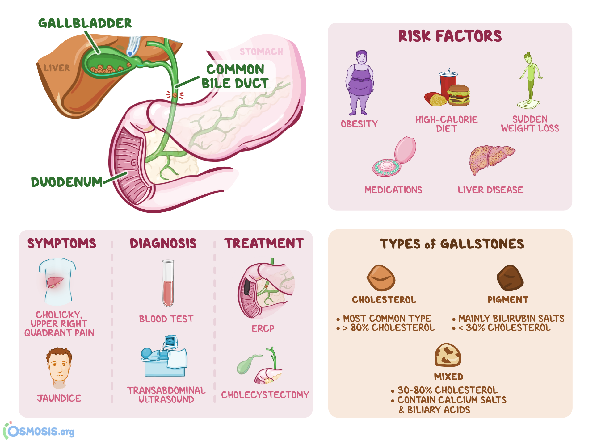 Coledocolitiasis Vs Colelitiasis