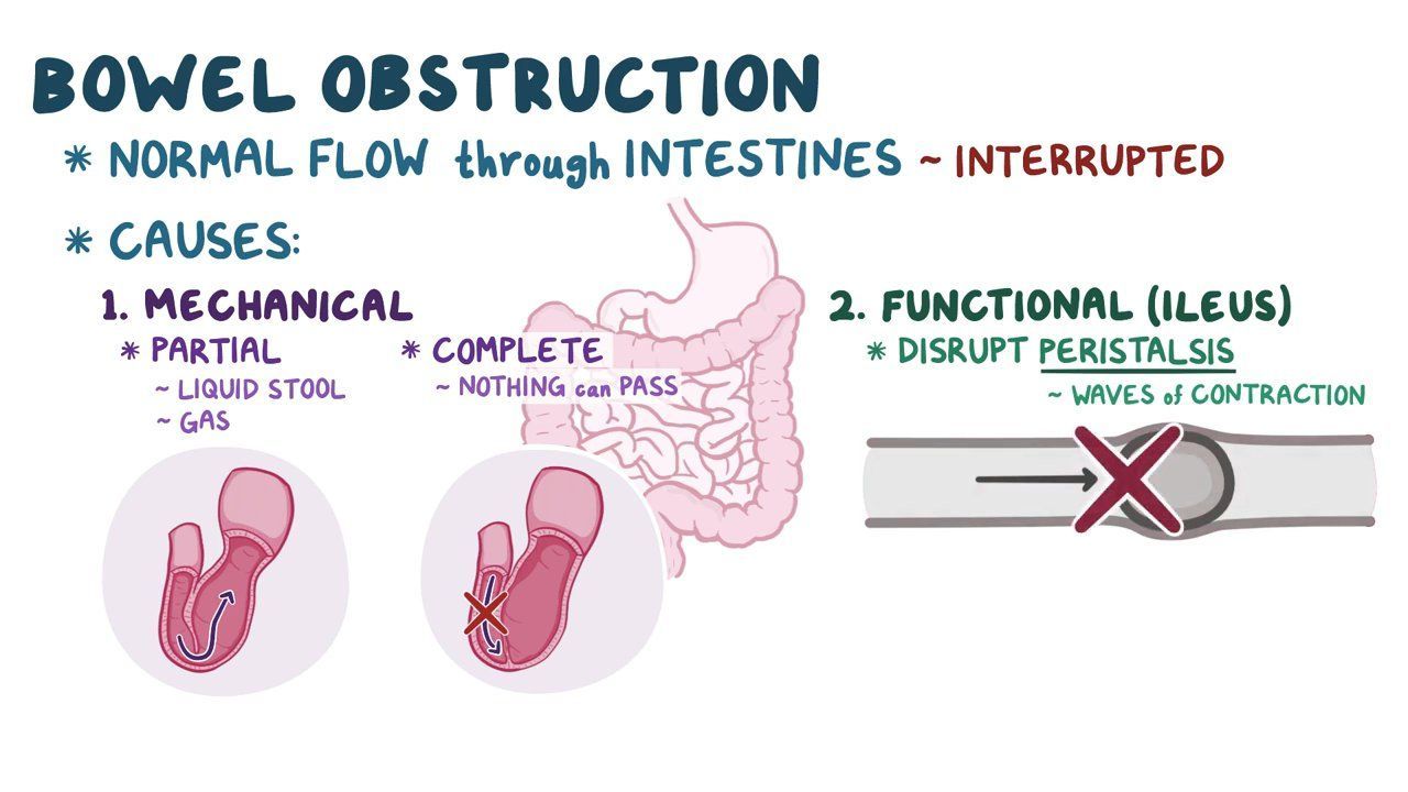 Laparoscopic Management Of Acute Intestinal Obstruction Omics Hot Sex