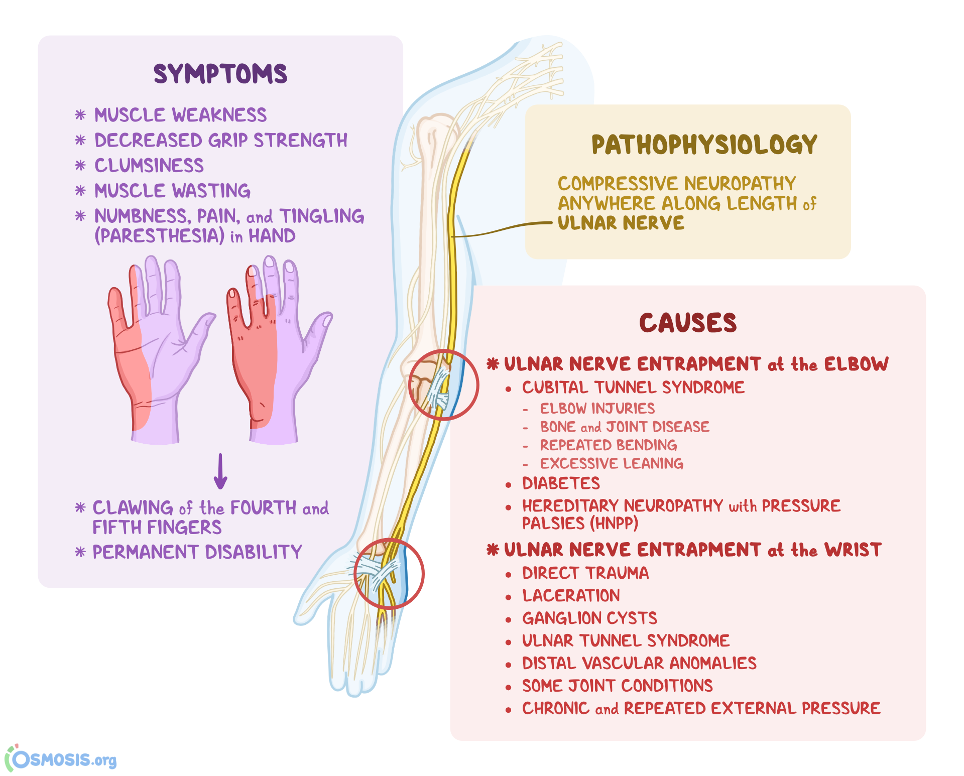 Ulnar Nerve Entrapment What Is It Symptoms Causes Treatment And