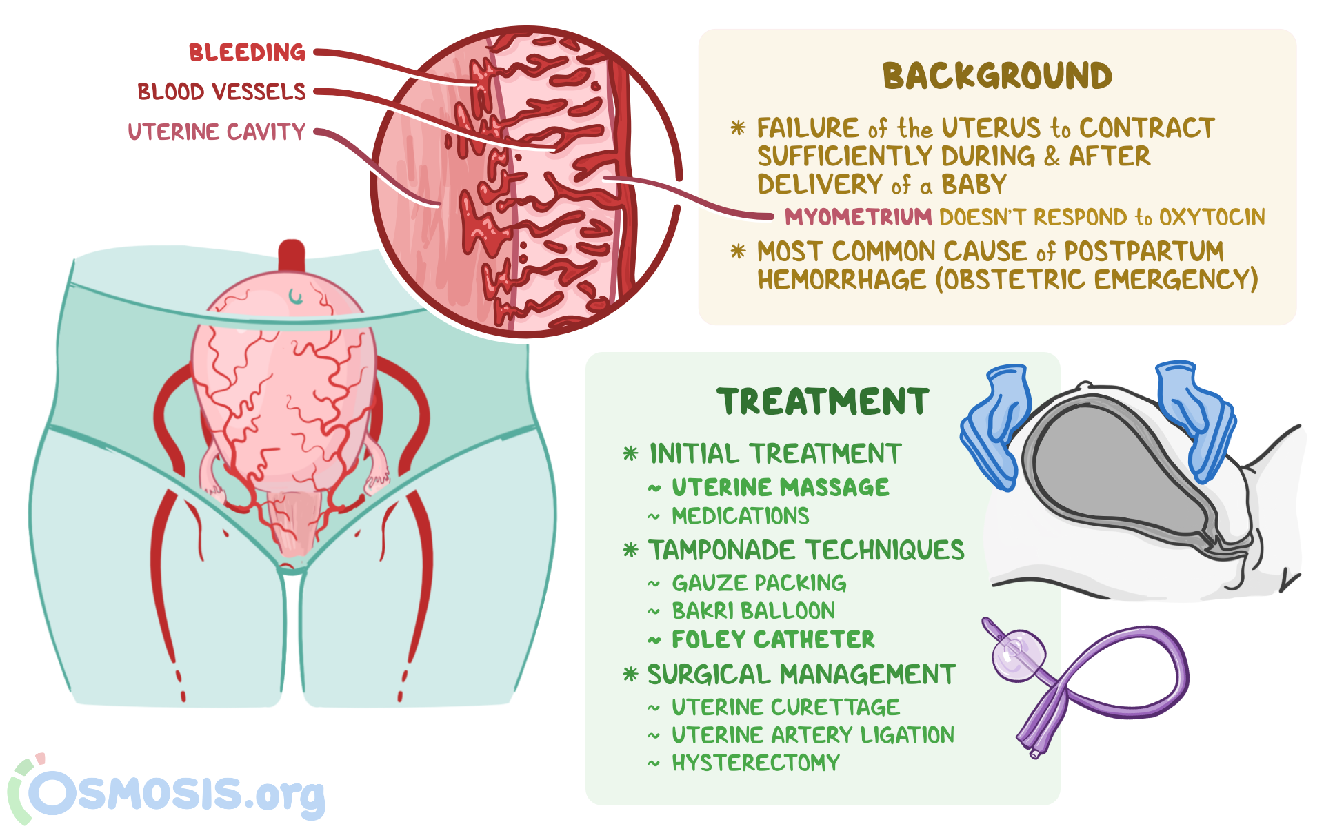 Postpartum Hemorrhage Management