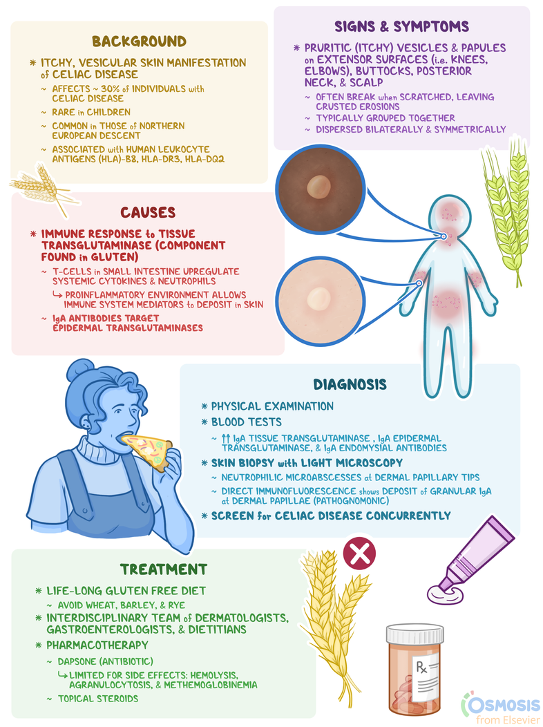Dermatitis Herpetiformis What It Is Causes Signs And More Osmosis