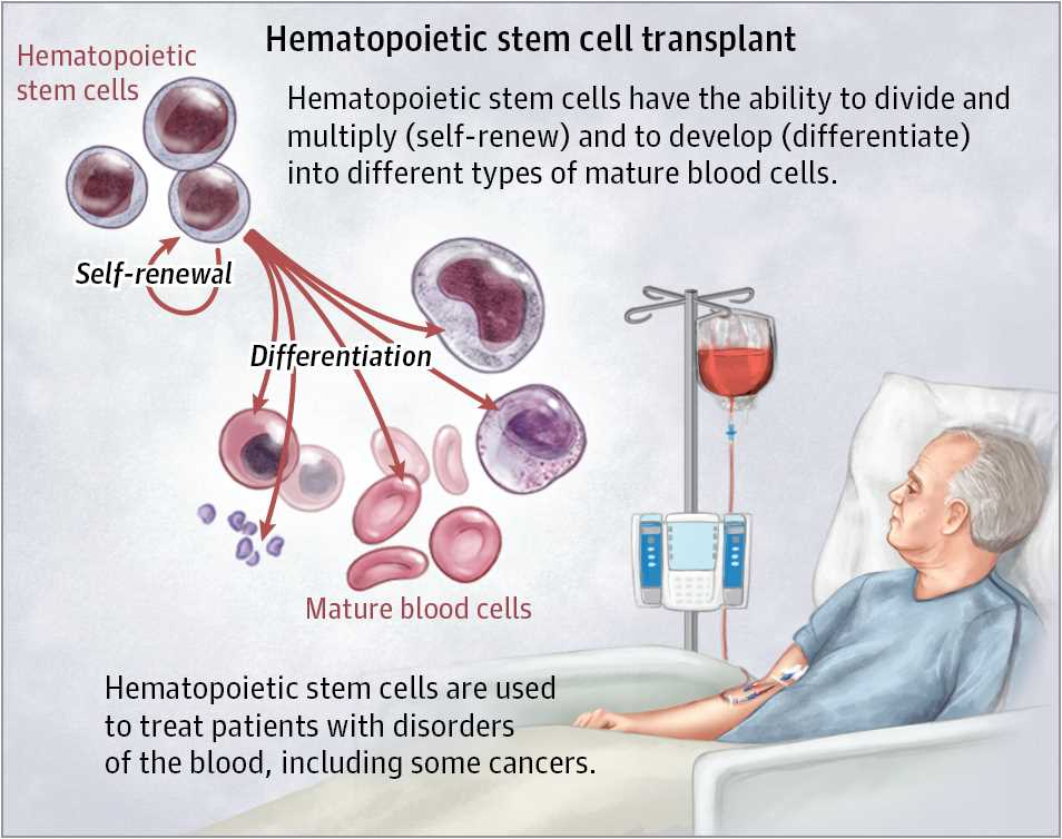 In News Hematopoietic Stem Cell Transplantations Hsct