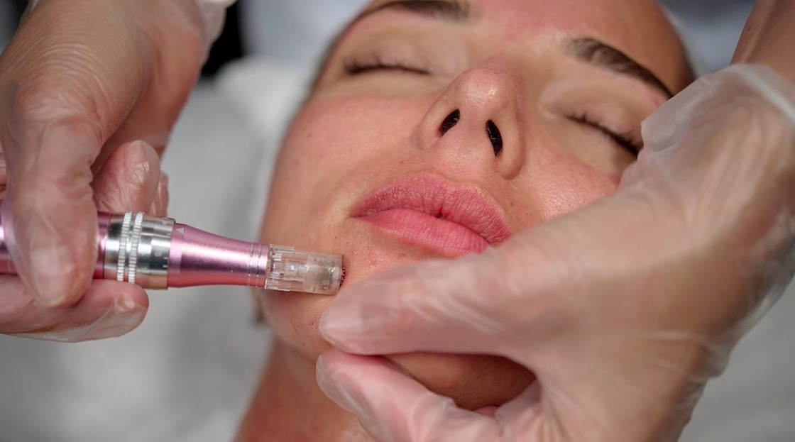 The Skin Benefits Of Mesotherapy And Microneedling